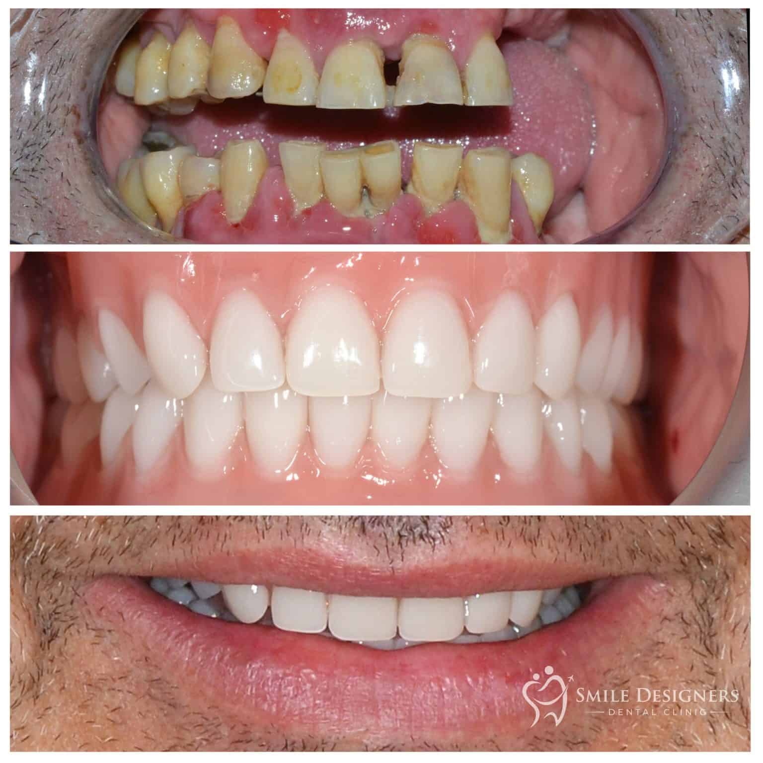 Implant, pivot, inlay-core: Quelle est la différence? - Smile Designers